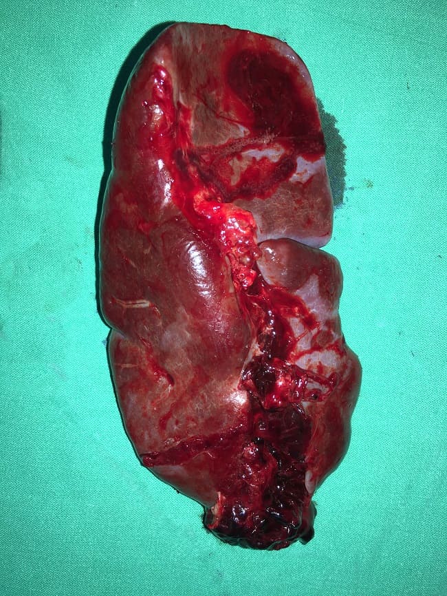 Edukasi dan Promosi Kesehatan Ruptur Limpa - Alomedika