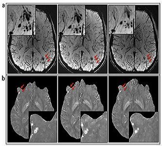 MRI Improves Diagnosis of Microbleeding after Brain Injury ...