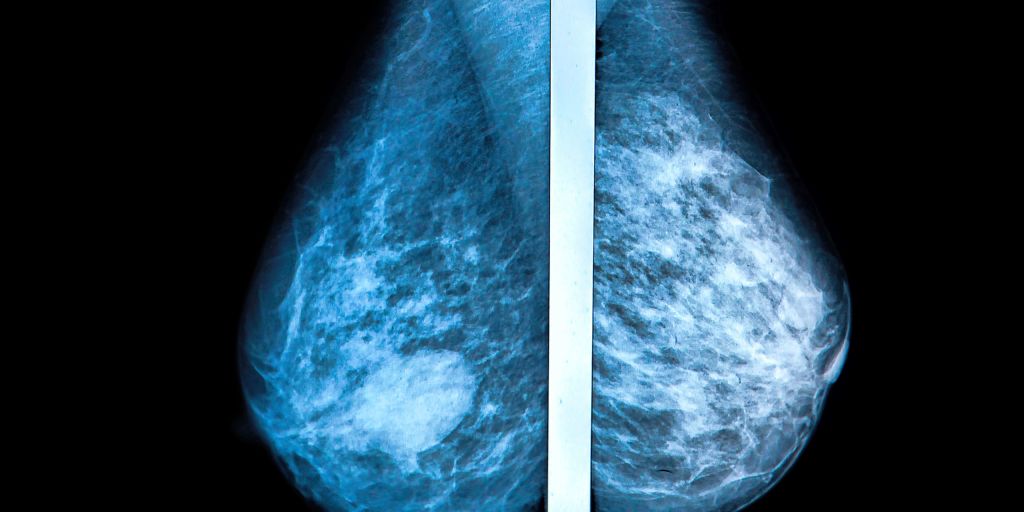 Fda Says Mammograms Must Include Breast Density Information Sharecare