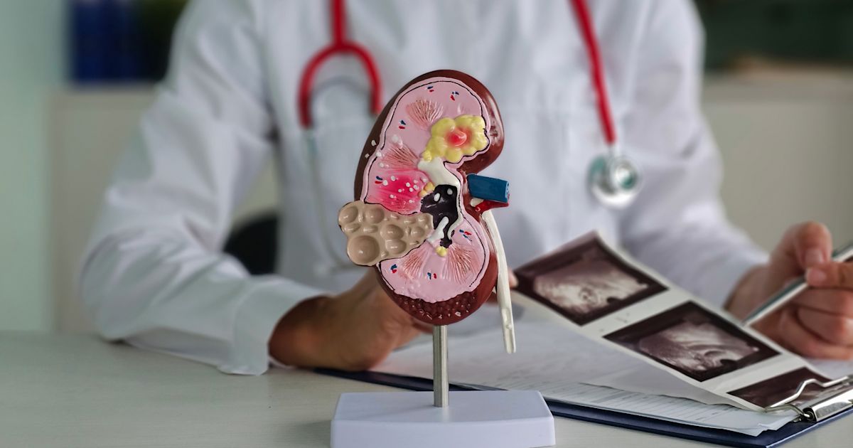 IgA nephropathy: understanding the complement system - Sharecare